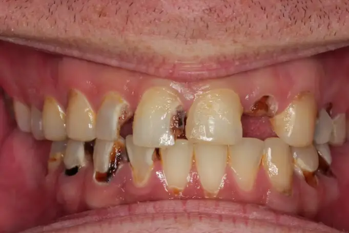 What is Meth Mouth? Symptoms, Causes and Treatment - Mental Health General