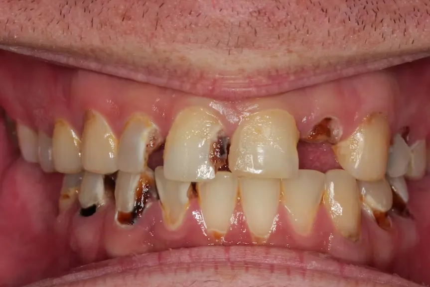 What is Meth Mouth? Symptoms, Causes and Treatment - Mental Health General